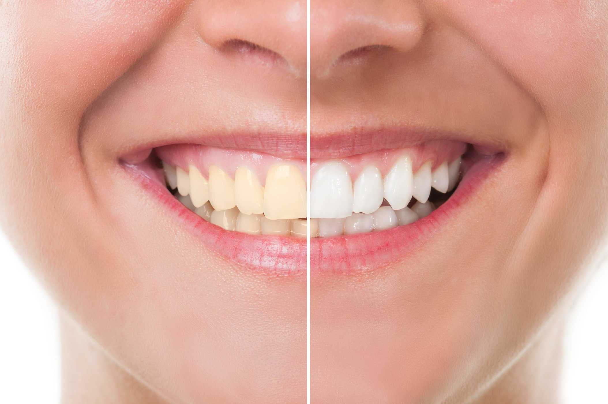 Memutihkan Gigi, Lebih Baik Bleaching atau Veneer? - Klinik Gigi J ...